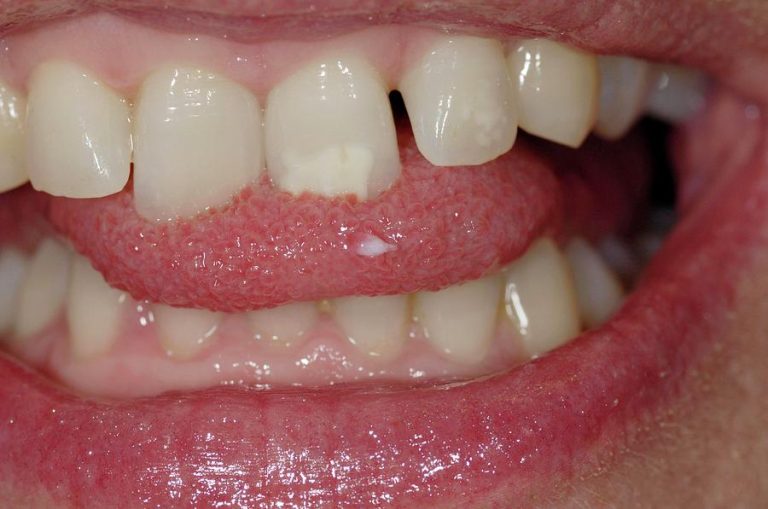 Papilloma Tongue: Why It Appears and How It Is Better to Remove It ...